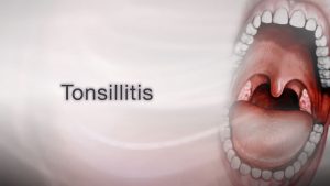 Tonsillitis: Risk Factors, Signs, Symptoms, Prevention, Tests ...
