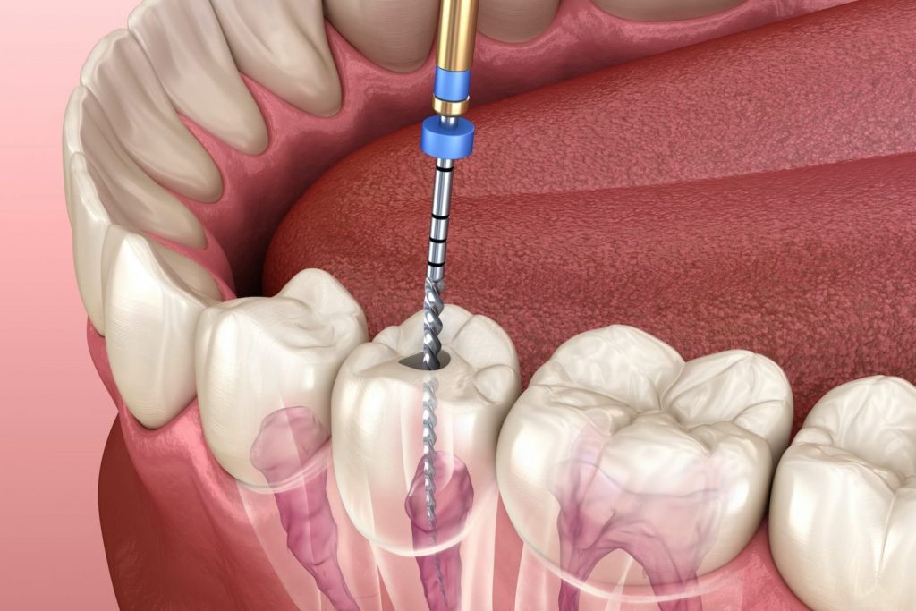 Root Canal Treatment - Yashoda Hospital