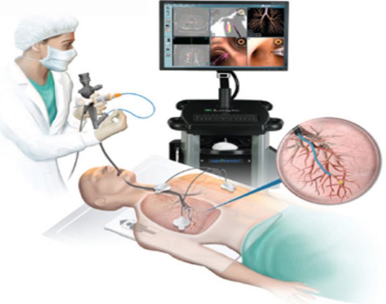 What is a Bronchoscopy & When do Doctors Recommend It?