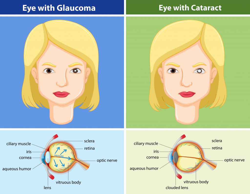 Cataract - Types, Surgery and Prevention
