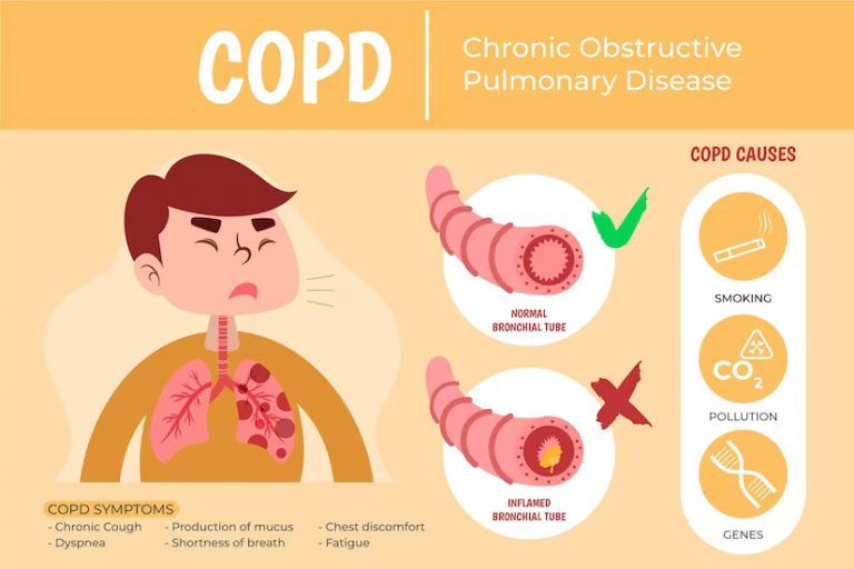 What is Chronic Obstructive Pulmonary Disease (COPD)