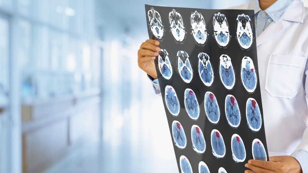 Types of Brain Tumor: Risk Factors, Signs and Symptoms